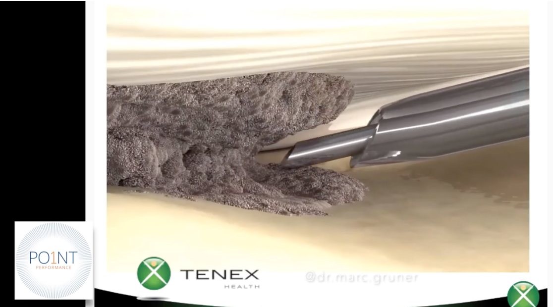 TENEX Procedure for Tendon Injuries: Video | Point Performance